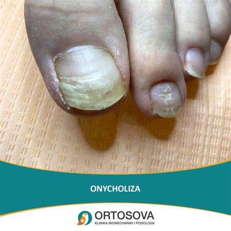 ONYCHOLIZA CZYM JEST I JAK SOBIE Z NIĄ RADZIĆ ORTOSOVA Centrum Medyczne