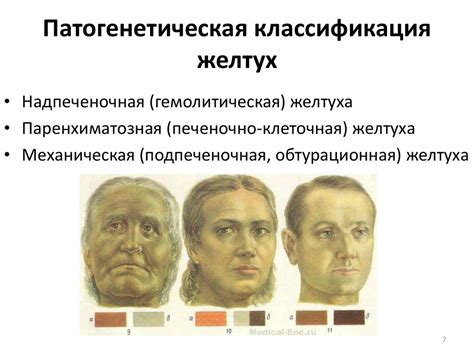 Желтуха истинная Желтуха ложная псевдожелтуха презентация онлайн