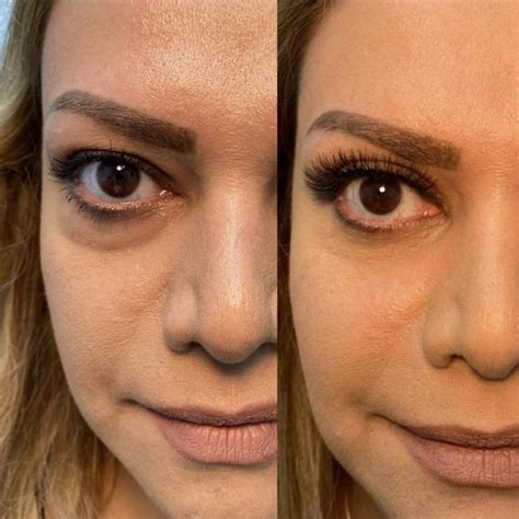 Patient 55495863 Blepharoplasty Eyelid Surgery Before And After