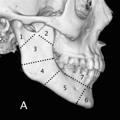 Mandible Fracture By Alexander Baxter Radnotes