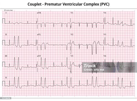 Couplet Premature Ventricular Complex Ecg Paper 12 Lead Stock