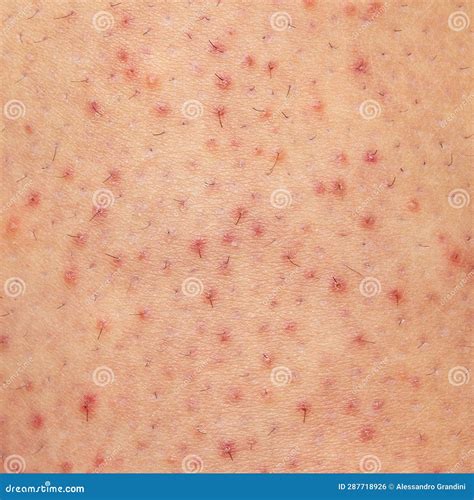 Folliculitis On Skin Hormonal Imbalance Royalty Free Stock