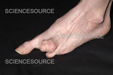 Scleroderma Stock Image Science Source Images