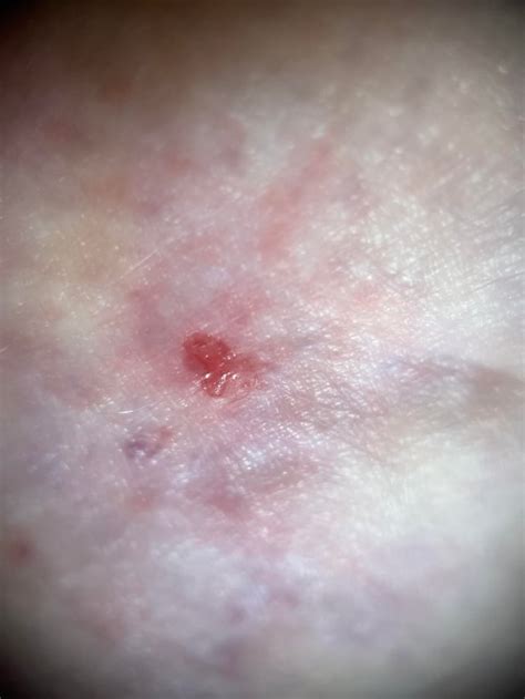Tiny Clear Worms In Skin And Stool Rdiagnoseme