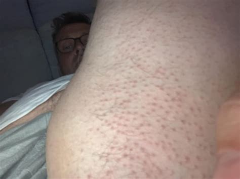 Hives Type Rashes Every Two Days Mainly On Thighs And Buttocks Happens