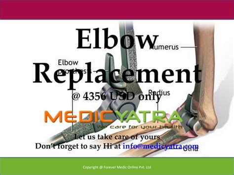 Elbow Replacement Surgery And Treatment Medicyatra Ppt
