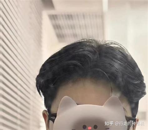 打工人熬夜压力大，头发一薅一大把，马上要秃了，有什么补救的方法？有什么控油去屑防脱的洗发水推荐？ 知乎
