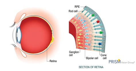 What Is A Retinal Tear Or Torn Retina Bethlehem Eye Associates