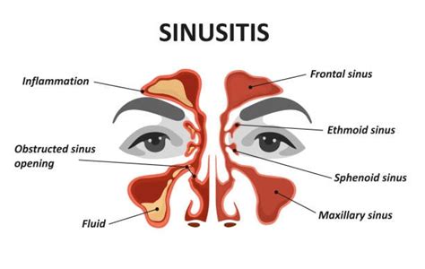 Relentless Sinusitis Visit Your Dentist Naperville Commons Dental