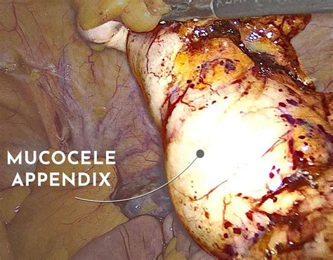 The Success Of Rare Mucocele Neoplasm Lman Appendix Surgery At Massh