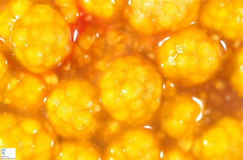 Lithiasis Human Pathology