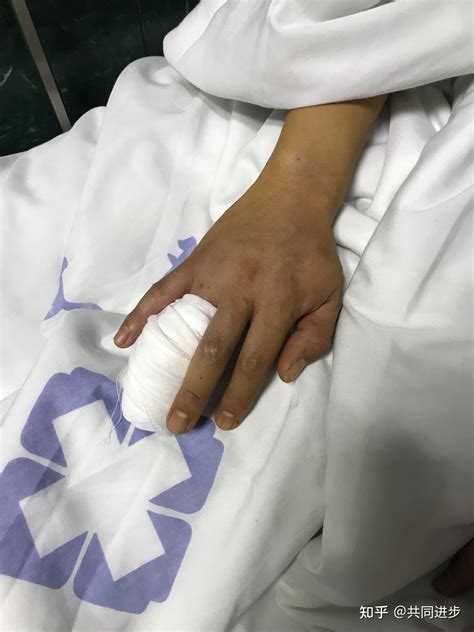 血管球瘤手术治疗 知乎