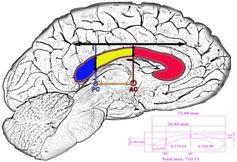 Colored Illustration Of The Corpus Callosum In A Midsagittal Section Download Scientific