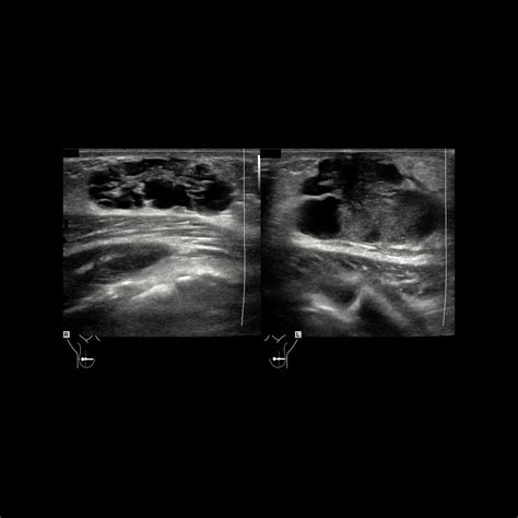 Pediatric Mastitis Pediatric Radiology Reference Article Pediatric