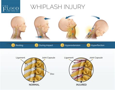 Whiplash Injury Froma Car Accident Connecticut Injury Attorney