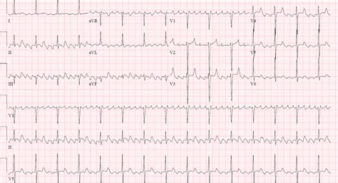 Typical Atrial Flutter Ekg