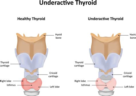 What Foods Make An Underactive Thyroid Worse Total Health