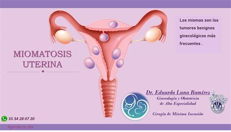 La Miomatosis Uterina Es El Dr Eduardo Luna Ramírez
