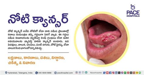 Choledocholithiasis Cbd Stone Symptoms Causes Complications