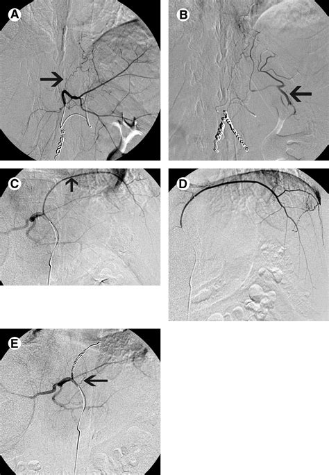 Technical Aspects Of Radioembolization With 90y Microspheres Techniques In Vascular
