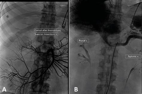 Control Splenoportography After Thrombolysis By Superior Mesenteric