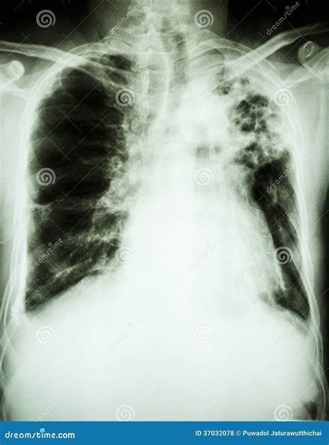 Pulmonary Tuberculosis Tb Chest X Ray Show Alveolar Infiltration At