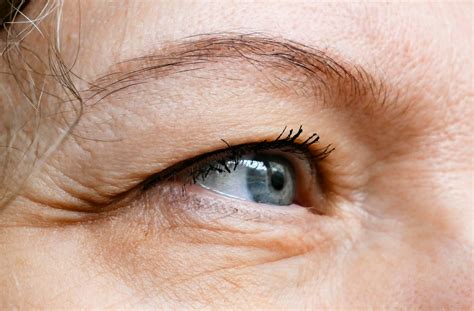 Ptosis Symptoms Causes And Treatments Iris