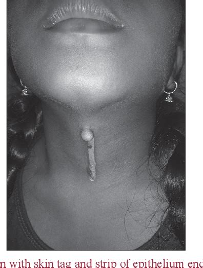 Figure 1 From Congenital Midline Cervical Cleft A Case Report On A