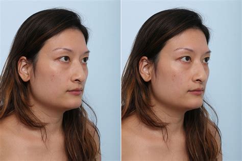 Juvederm Voluma Xc Before And After Photos Dr Vitenas