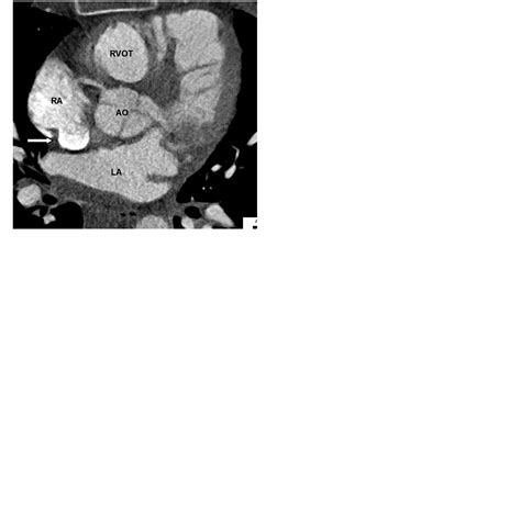 Crista Terminalis Mri