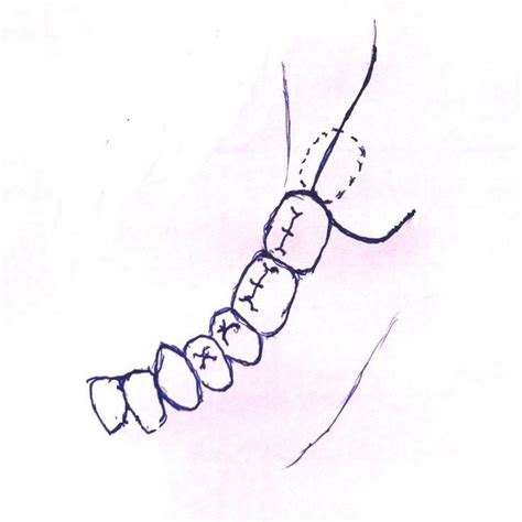Pdf Modified Flap Design For Lower Third Molar Surgery A Short Patient Based Outcome