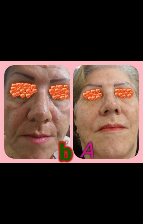 Ratin دوستان سلامتزریق چربی به همراه پی آر پی یکی از بهترین و