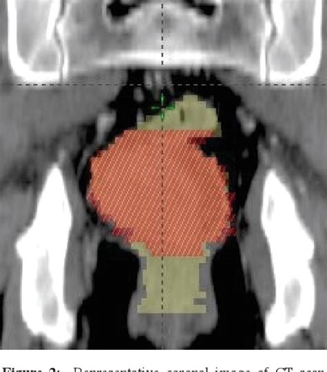 Figure 2 From Impact Of Integrated PET CT On Variability Of Target