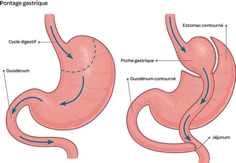 Bypass Gastrique Cabinet De Chirurgie Générale Et De Lobésité Fès