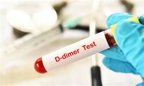 D Dimer Testing Effective For Screening Acute Aortic Syndromes With