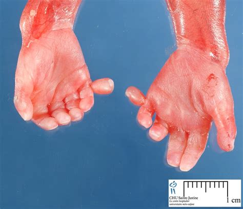 Post Axial Polydactyly Human Pathology