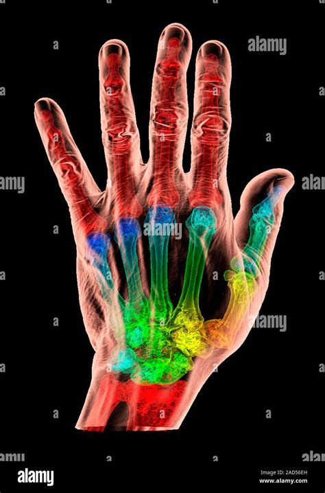 Fracture Du Pouce 3d Couleur Scanner Montrant La Peau Et Les Os Dans