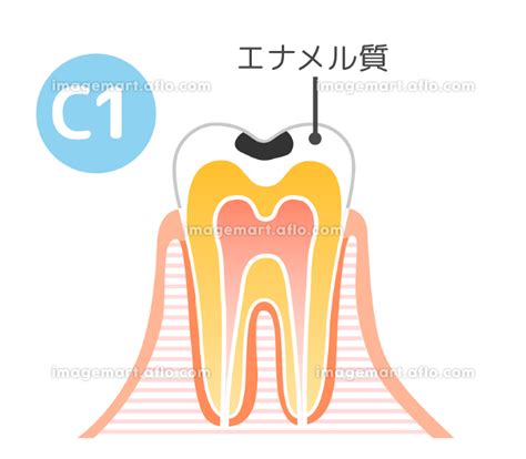 虫歯の進行とc1〜c4のイラスト素材 197047357 イメージマート