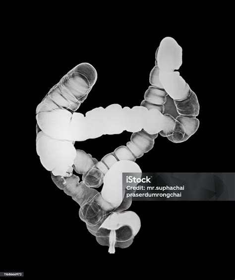 대장암 검출을 위한 대장의 해부학적 위치를 나타내는 대장의 바륨 관장 이미지 또는 엑스레이 이미지 클리핑 경로 X 레이에 대한 스톡 사진 및 기타 이미지 Istock