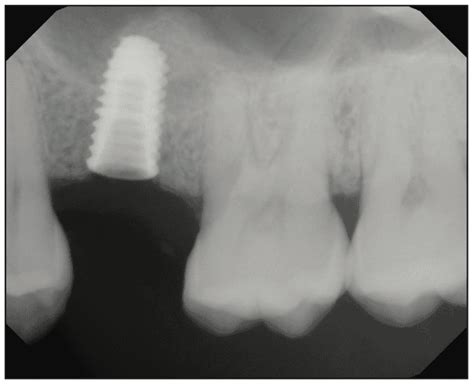 Contemporary Approach On Sinus Augmentation Dentistry Today