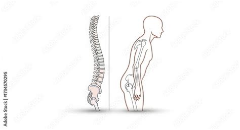 Skeletal Illustration Depicting Both A Healthy Spinal Column And A Human Profile With The