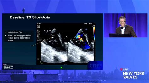 Case Presentation 1 T Teer With Triclip In A Patient With Atrial Functional Tr