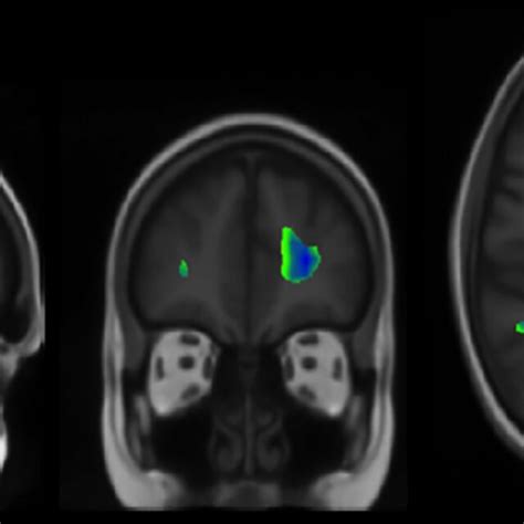 Omnibus F‐maps Visualized Using Fsl‐eyes Visualization Tool Show Download Scientific Diagram