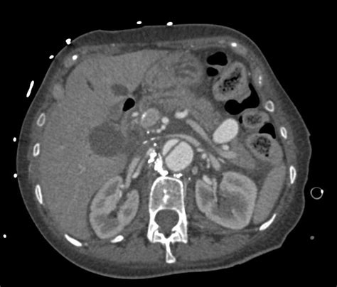 Ct Findings Of A Prior Lymphangiogram Gastrointestinal Radiology Case