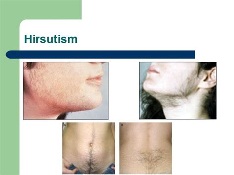 Hirsutism And Hypertrichosis