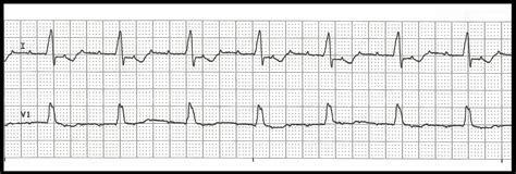 Type Ii Atrial Flutter Icd 10 Bezycandy