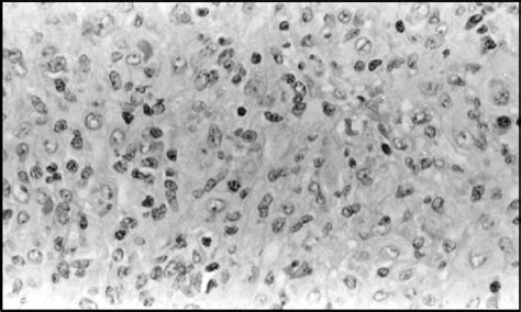 B Endobronchial Inflammatory Pseudotumor Of Lung Histopathological