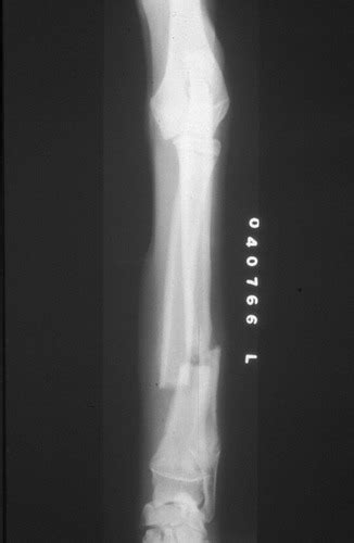 Fracture Types Flashcards Quizlet