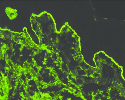 Immunofluorescence Microscopy Shows Linear Deposits Of Igg Along The Download Scientific