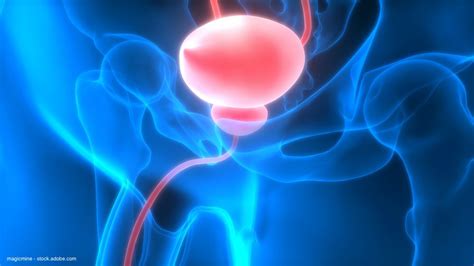 Gemcitabineradiation Shows Sustained Success For Bladder Preservation